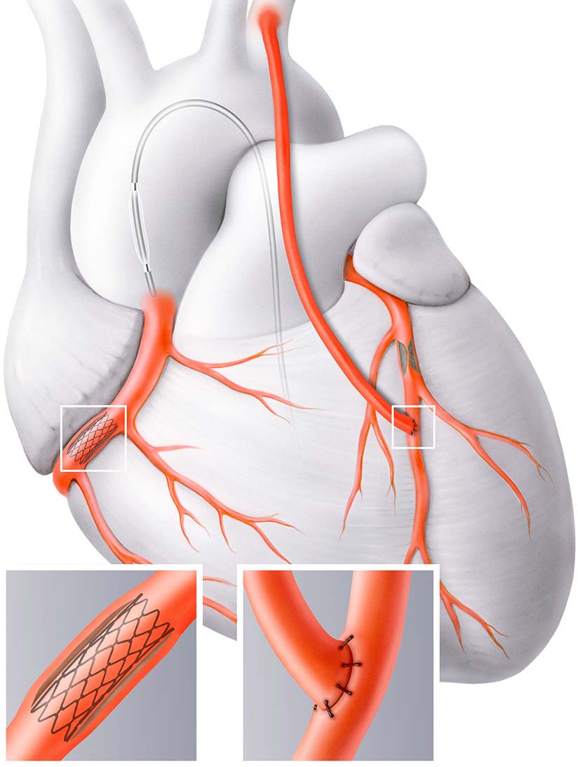 Bypass coronarian sau angioplastie cu stent? – Cardiologie București ...